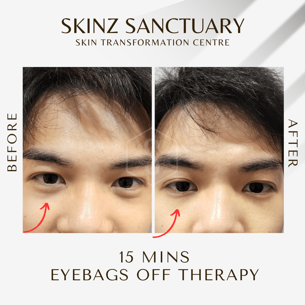Eye Area Rejuvenation: 5 Tips to Revitalize Your Appearance
